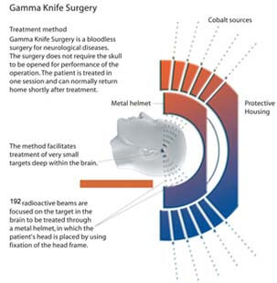 Low Cost Gamma Knife Surgery in India - Gamma Knife Radiosurgery in india