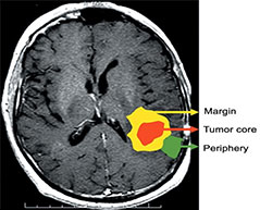 Gliadel Wafer Surgery Cost in India|Top Neurosurgeons for Glioblastoma ...
